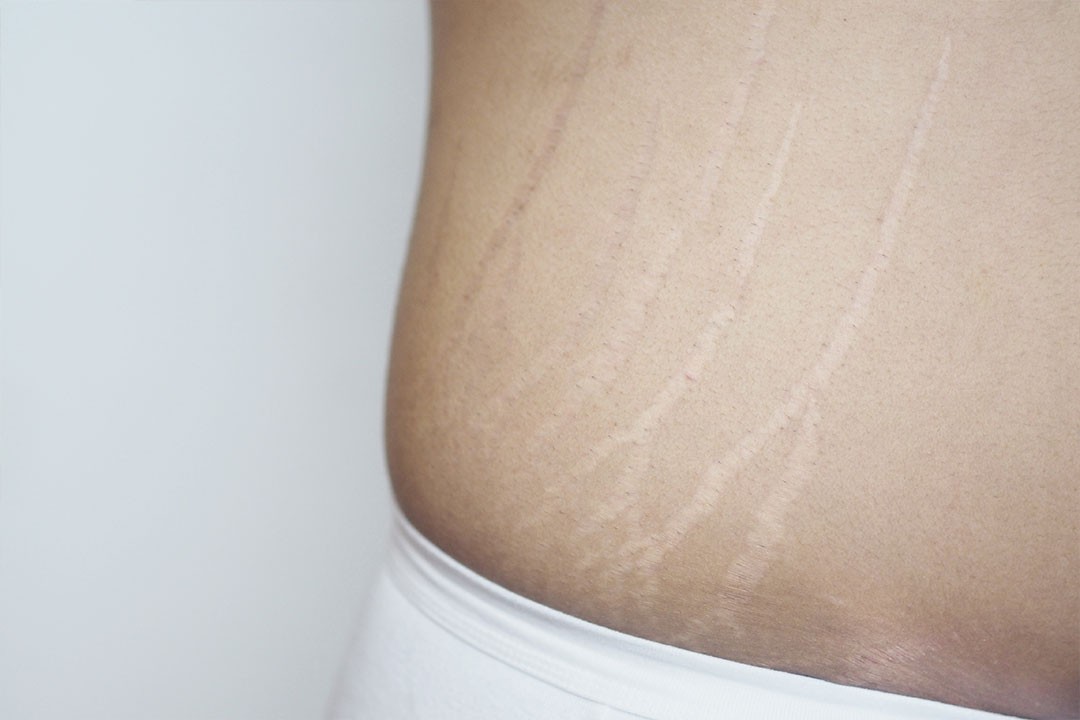 How to Treat Stretch Marks 101: All You Need to Know | Mederma®