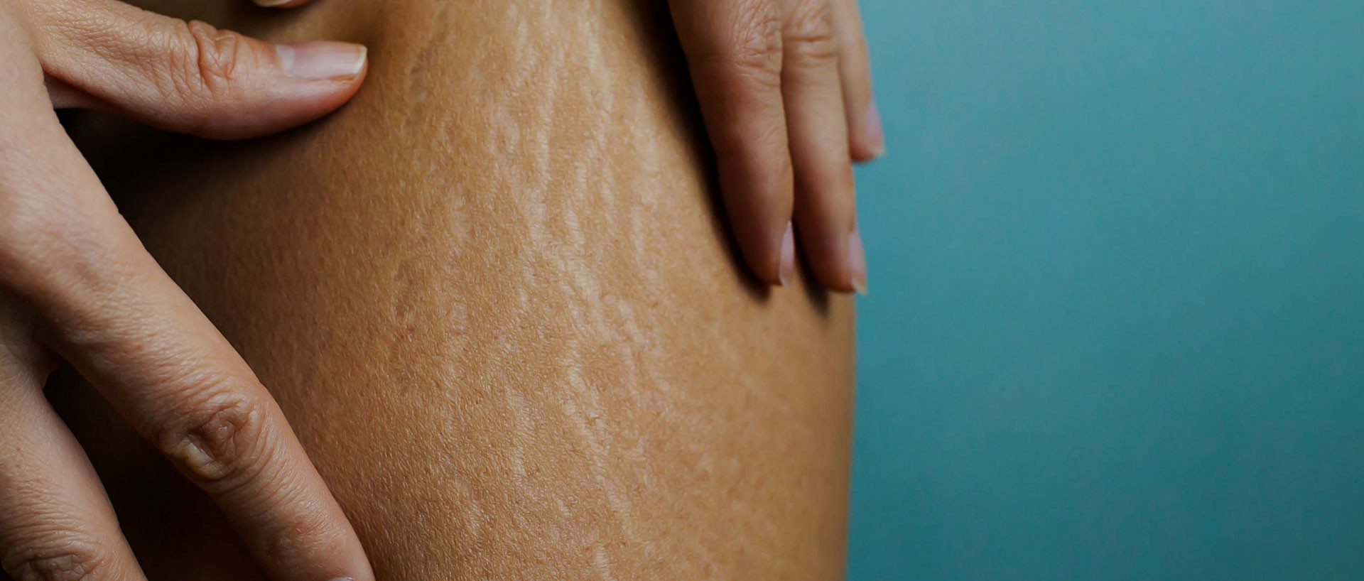 Skin Care For Scars Scarring And Stretch Marks Mederma®