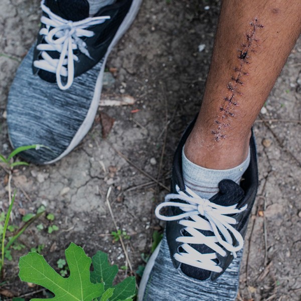 Education for Scar, Stretch Marks & Cold Sores | Mederma®