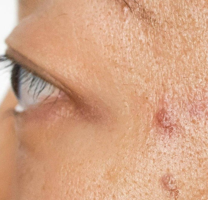 Education for Scar, Stretch Marks & Cold Sores | Mederma®